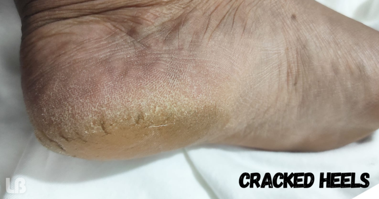 How To Fix Cracked Heels Permanently